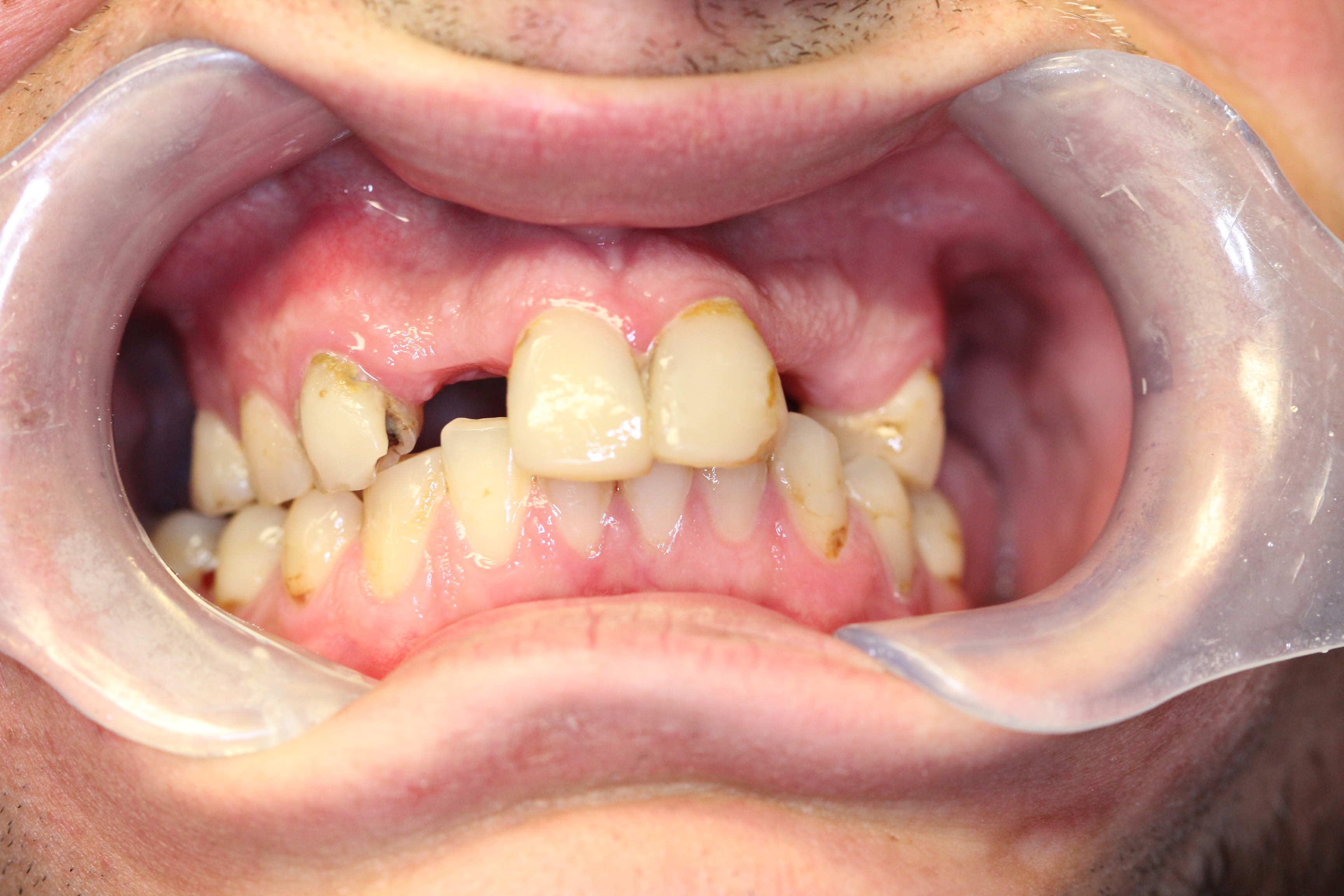 Smile Gallery Killeen Oral & Maxillofacial Surgery | Before & After